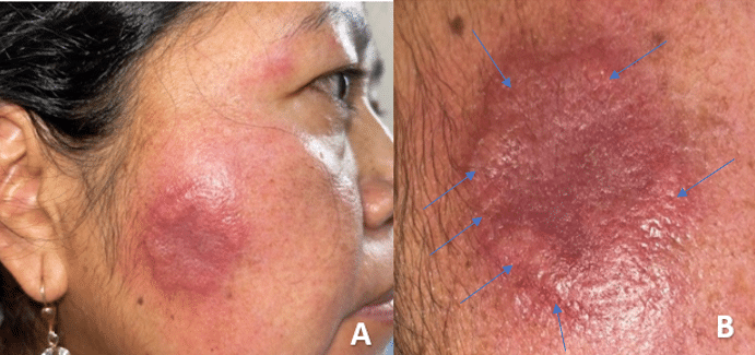 Nodulomatosis: A Report of Two Cases