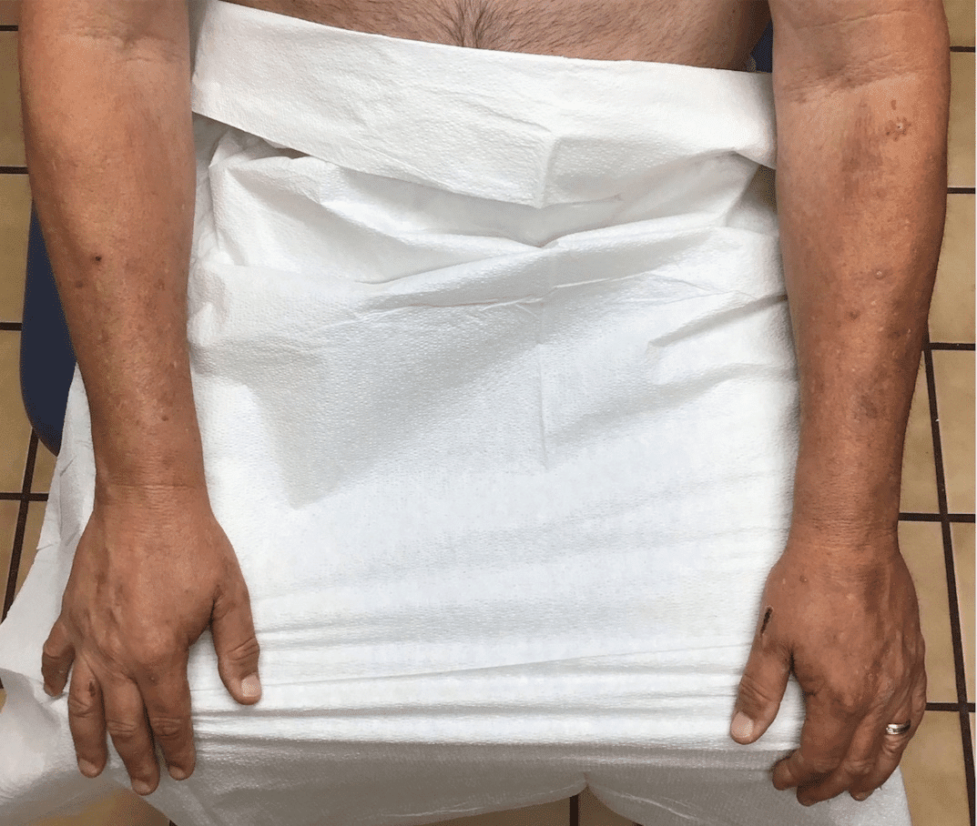 the Treatment of Prurigo Nodularis