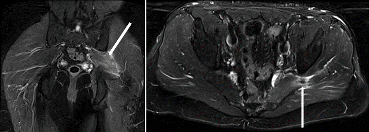 Calcific Piriformis Tendinitis in a Patient