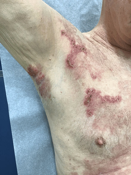 Case Report of Hailey-Hailey Disease Successfully
