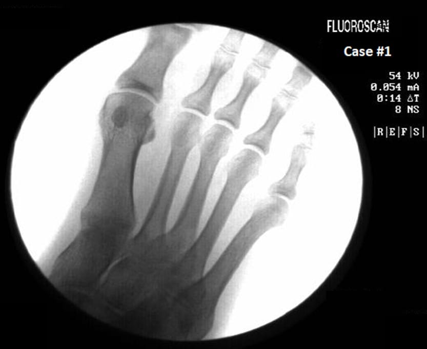 Misdiagnosis: Hallux Sesamoid Fractures in US Air Force
