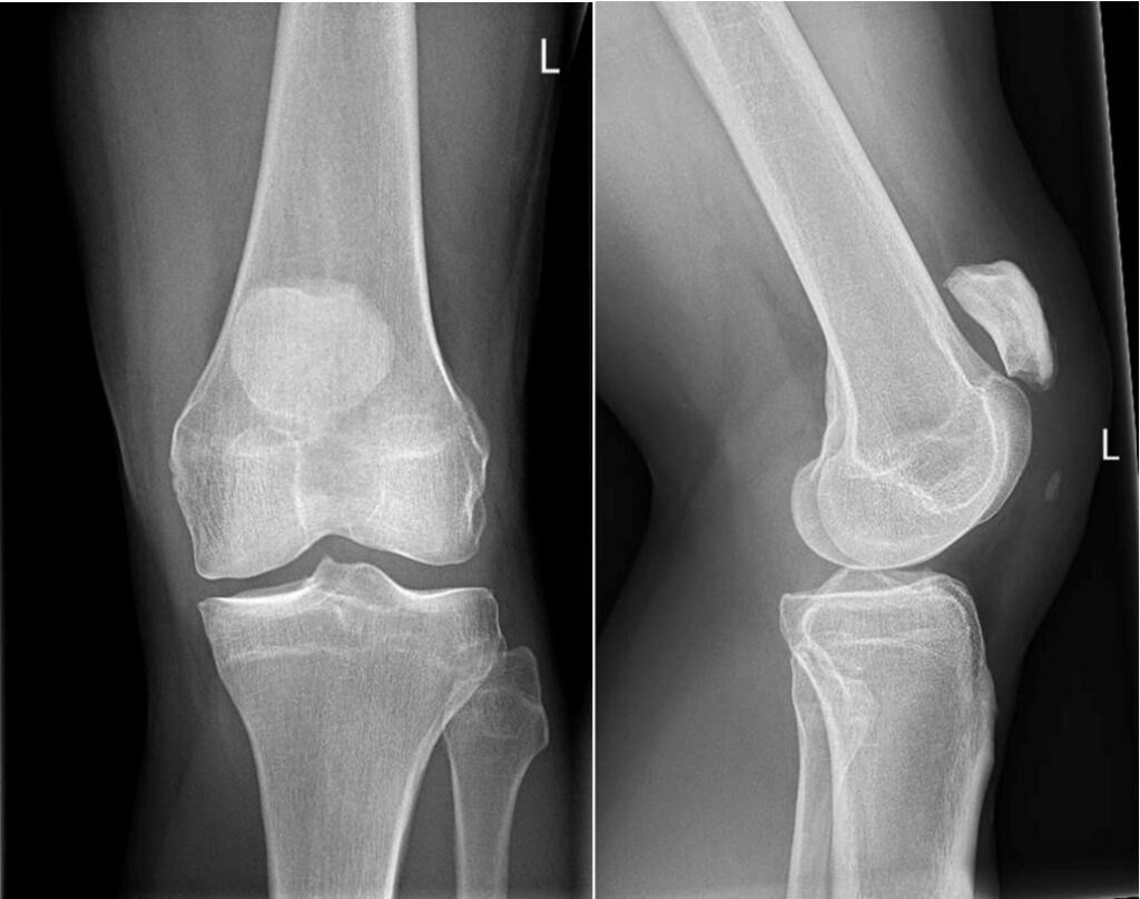 Patellar Tendon Rupture with Intact Overlying Prepatellar Quadriceps ...