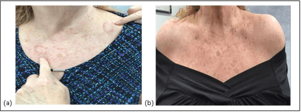 Successful Treatment of Granuloma Annulare with Tapinarof 1% Cream: A ...