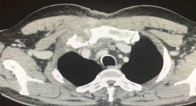 Functional Upper Limb Assessment After Sternal Clavicular Joint ...