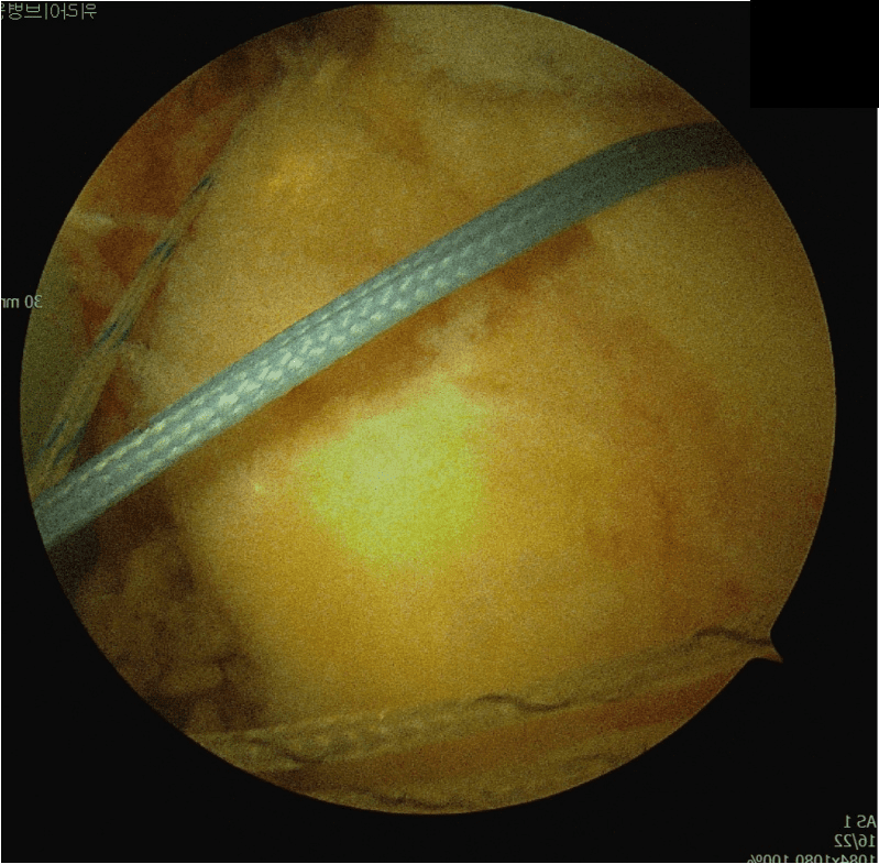 A Retrospective Evaluation of Biologic Tuberoplasty with Medialization ...