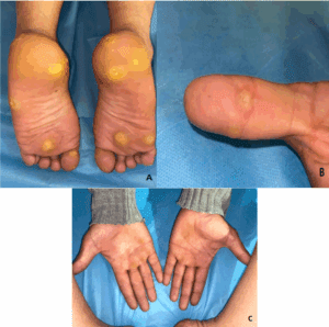 Punctate Palmoplantar Keratoderma: Case Report - Athenaeum Scientific ...