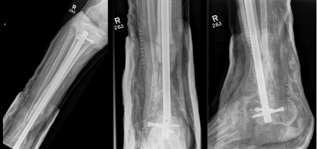 Retrograde Tibia Intramedullary Nailing
