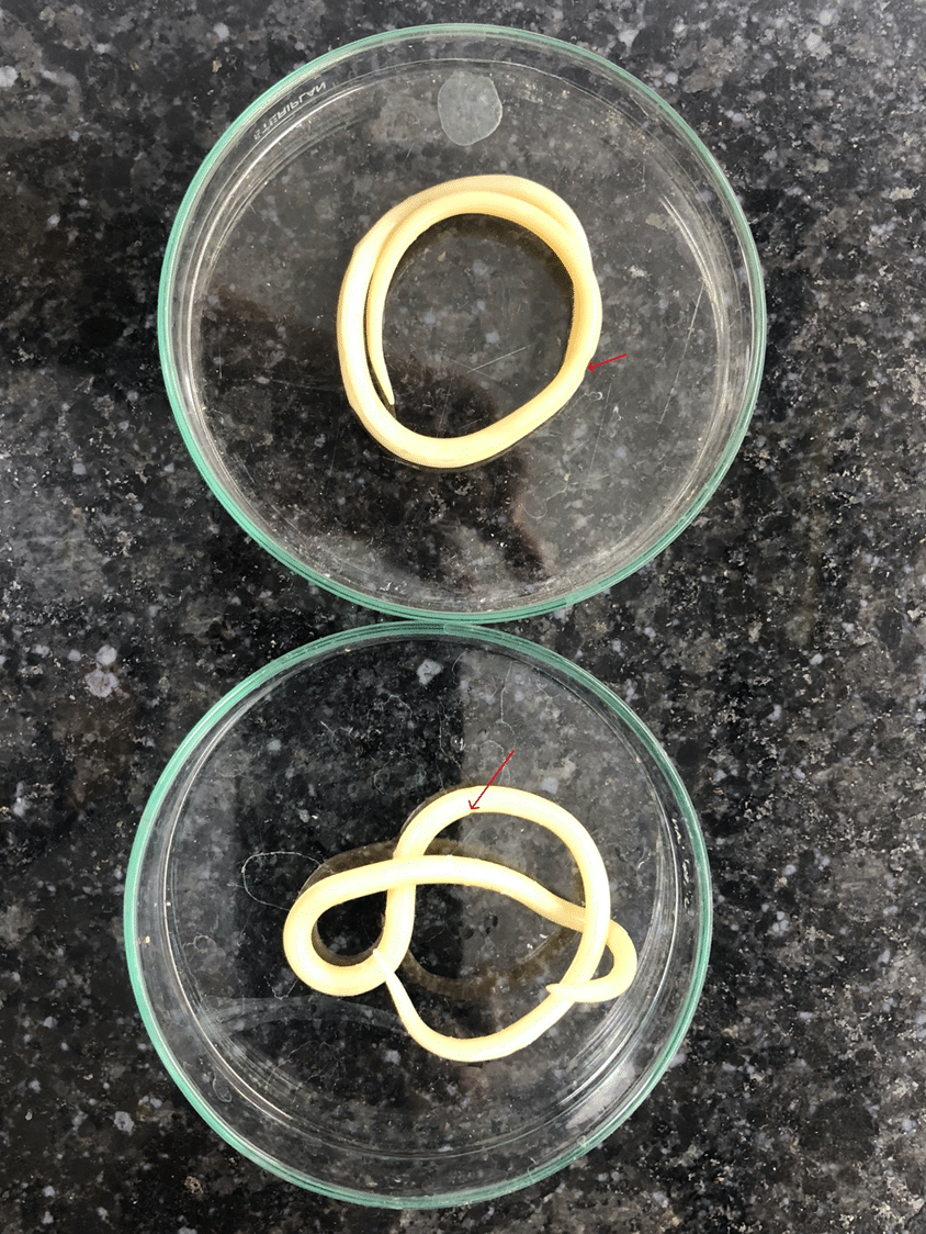 A Case of Fatal Disseminated Ascariasis