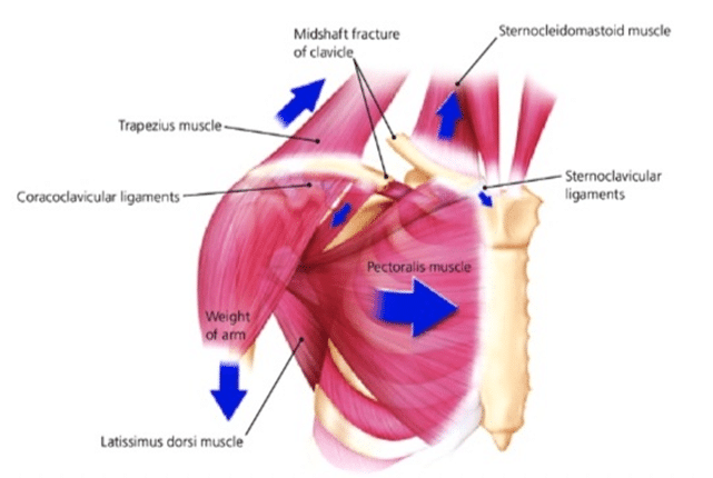 Conservative Treatment of Medial Shaft...