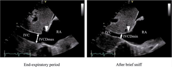 Diameter IVC Across Age Groups - Athenaeum Pub