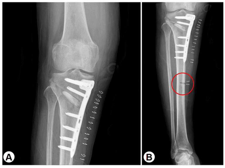 Medial Open-wedge High Tibial Osteotomy