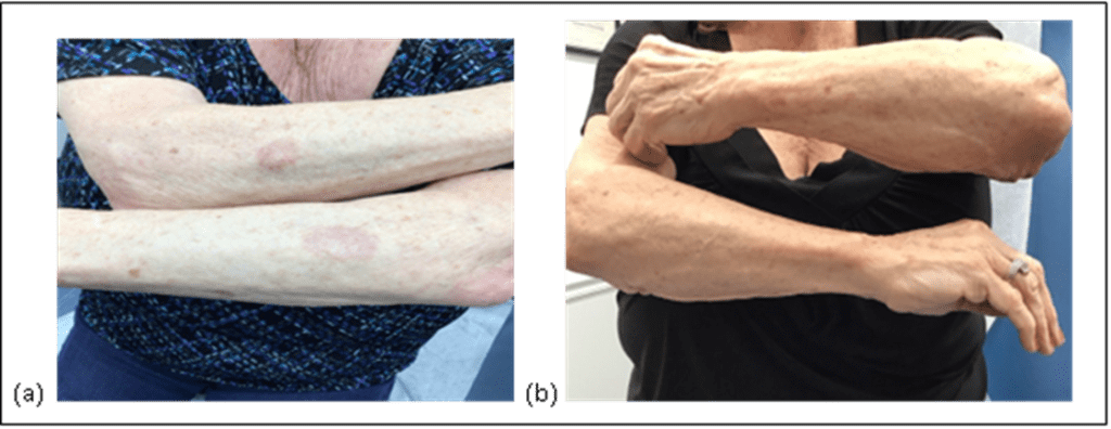 Successful Treatment of Granuloma Annulare with Tapinarof 1% Cream: A ...