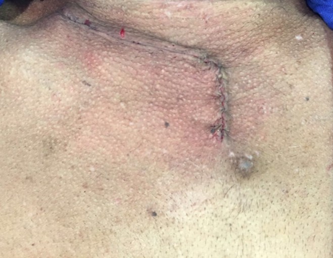 Functional Upper Limb Assessment After Sternal Clavicular Joint ...