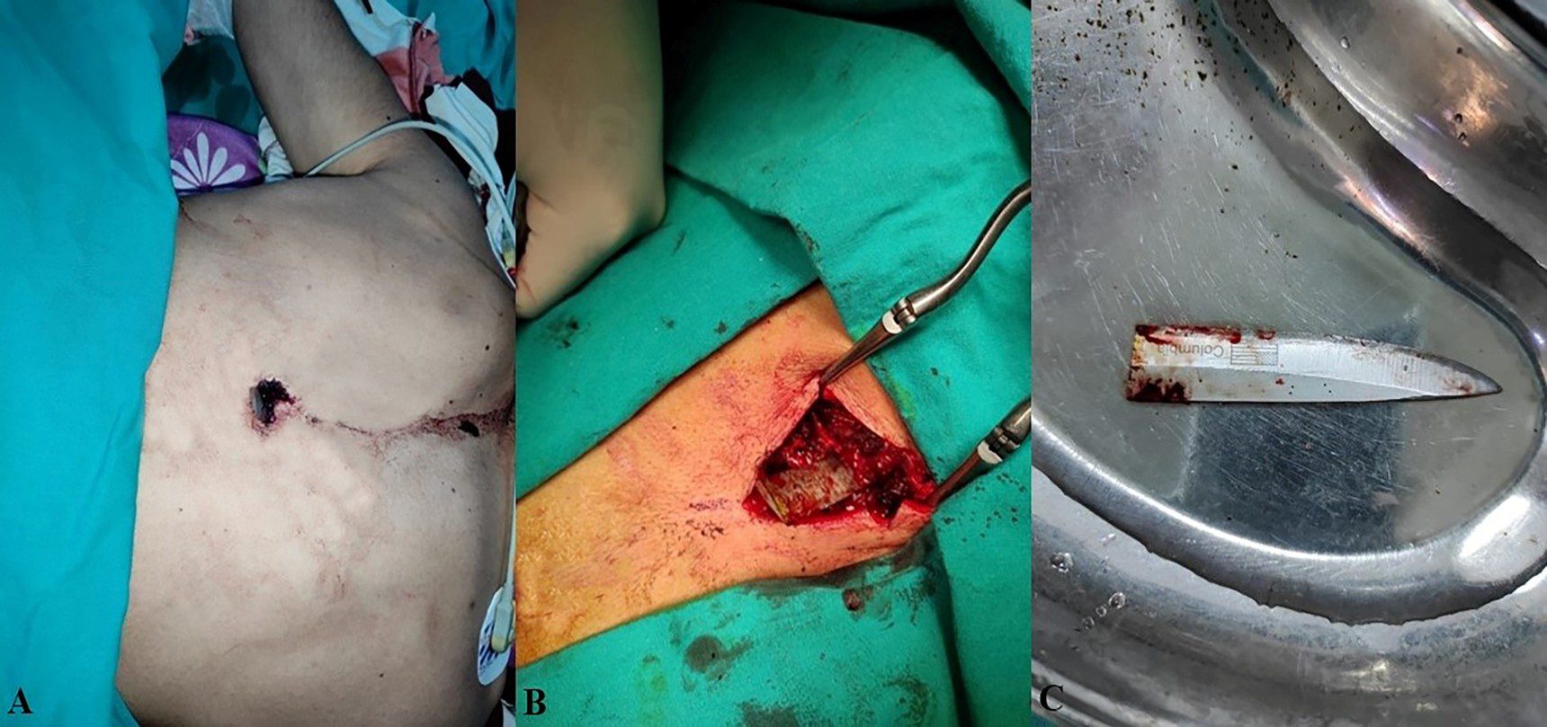 Penetrating Stab-Wound Injury of the Thoracic Spinal Cord Without ...