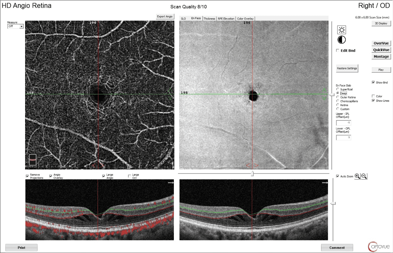 Optical Coherence Tomography Angiography for Macular