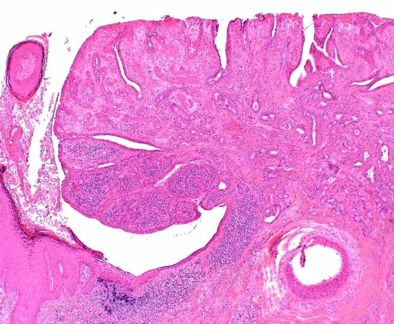 Complex Skin Lesion with Multiple Diagnoses: Case Report
