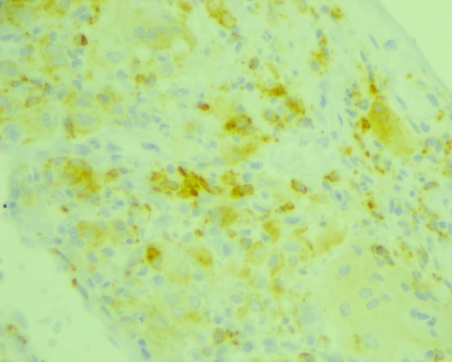Atypical Fibroxanthoma of the Scalp in a Young Woman...