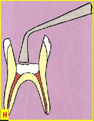 Endodontic Therapy for Primary and Young