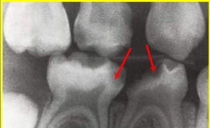 Endodontic Therapy for Primary and Young