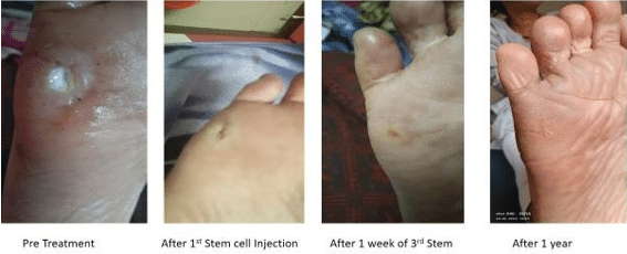 Human Umbilical Cord Mesenchymal Stem Cells in Scleroderma