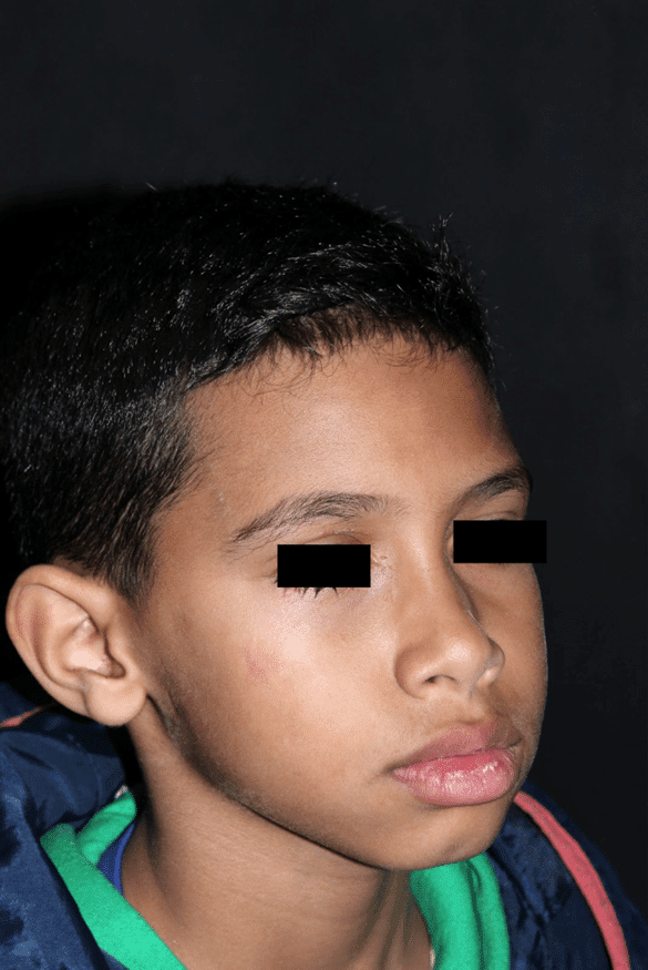 Pediatric Patient: Case Report....