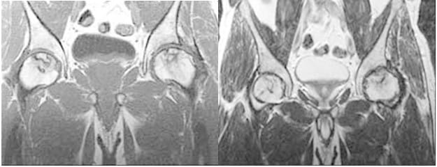 Potential Stem Cell Treatment For Common Hip Conditions Osteoarthritis 6863