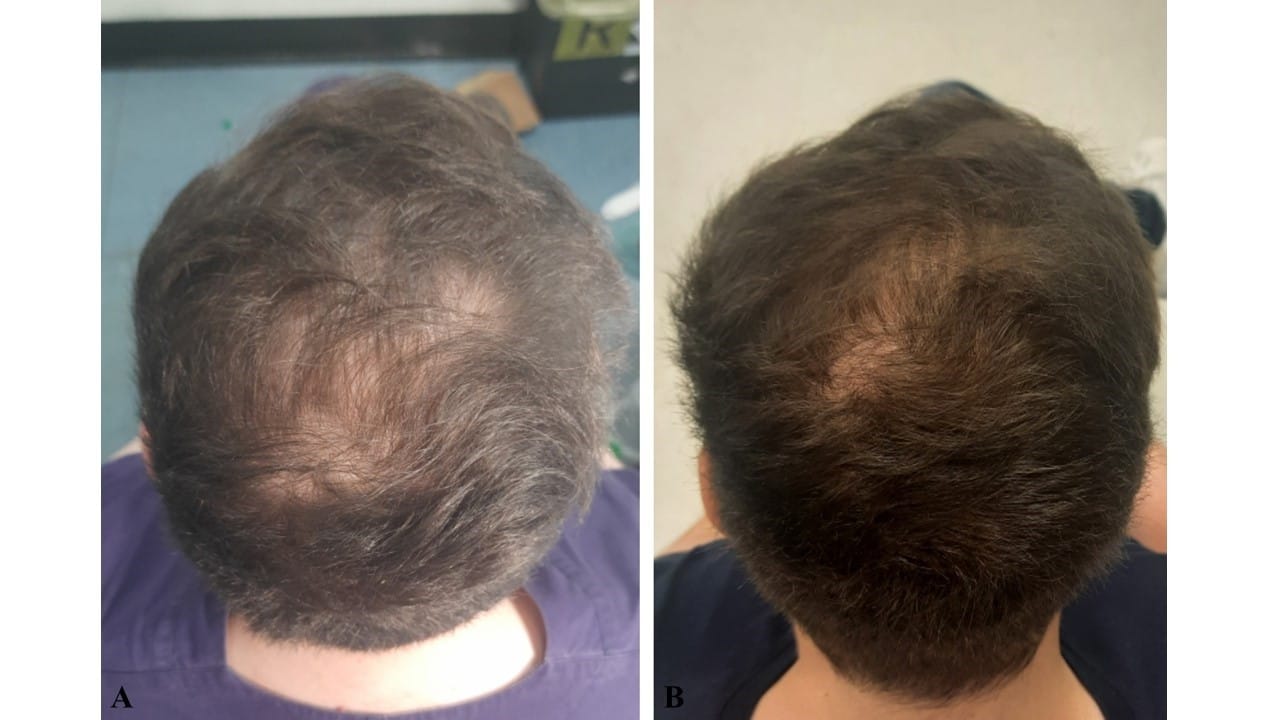 Androgenetic Alopecia: A Study on The Efficacy of a Combined Protocol ...