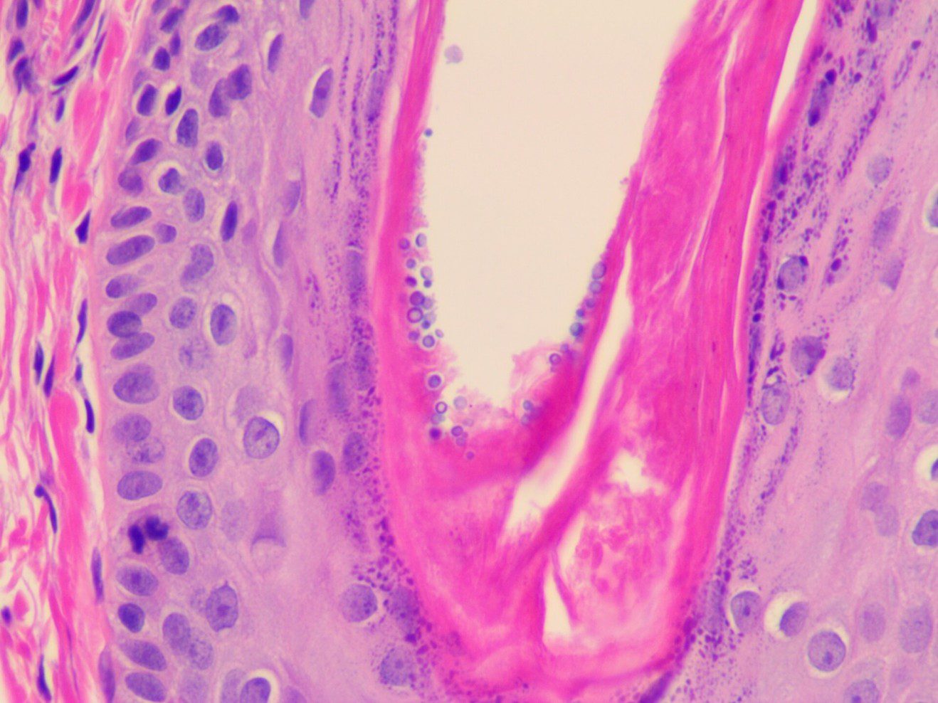 Successful Treatment of Pityrosporum Folliculitis with Isotretinoin ...