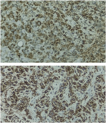 An ALK-Positive Anaplastic Large Cell Lymphoma with Striking Cutaneous ...