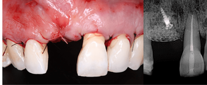Clinical Management of Titanium Mesh Exposure Following Guided Bone ...