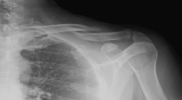 Conservative Treatment of Medial Shaft...