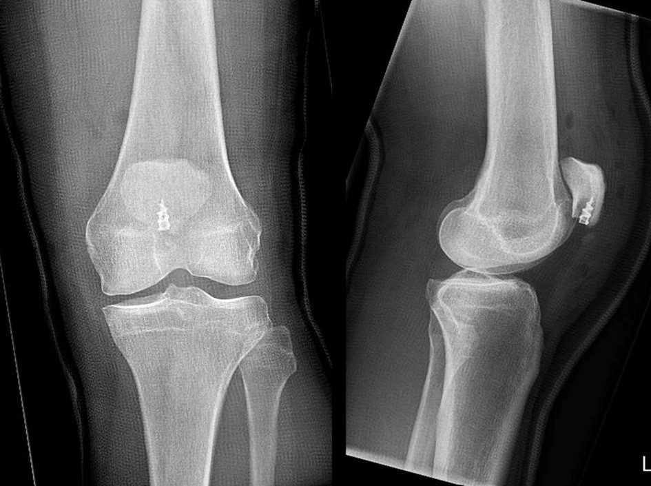 Patellar Tendon Rupture with Intact Overlying Prepatellar Quadriceps ...