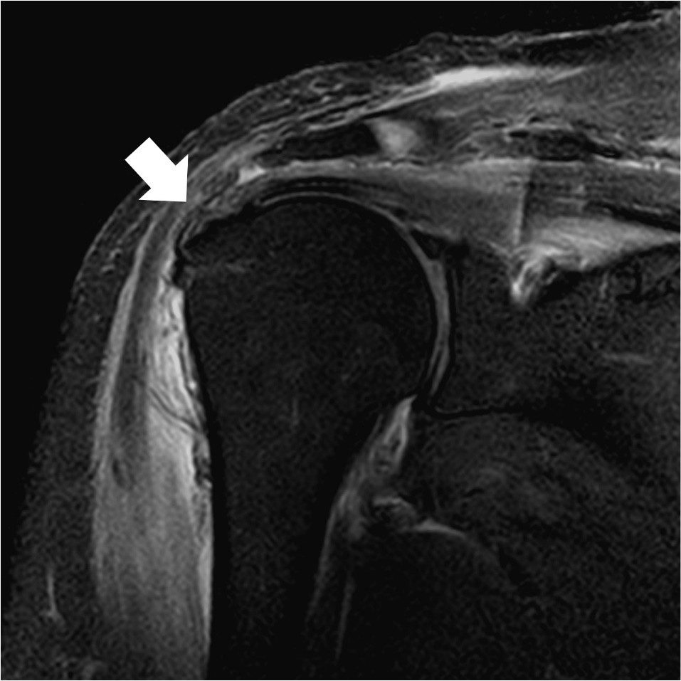 Treatment of Partial-Thickness Rotator Cuff Tears with Bio-Inductive ...