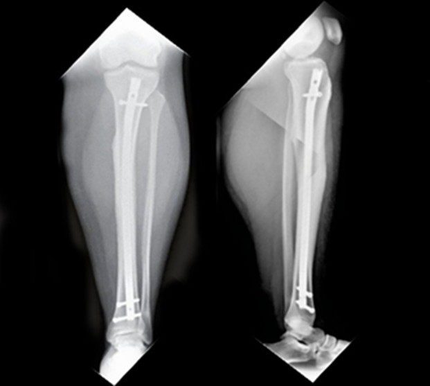 A Case of Chronic Bilateral Tibial Stress Fractures Treated with ...