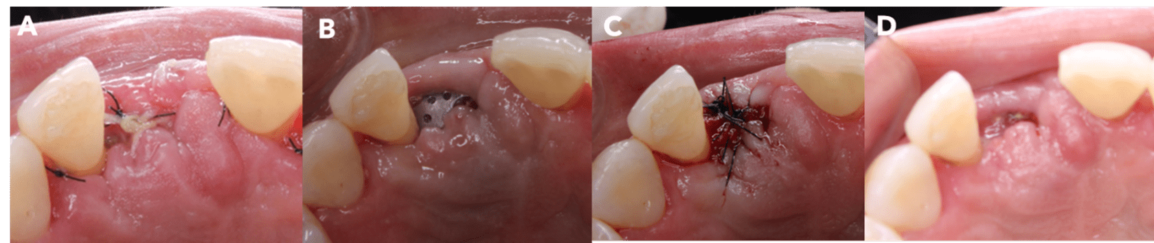 Clinical Management of Titanium Mesh Exposure Following Guided Bone ...