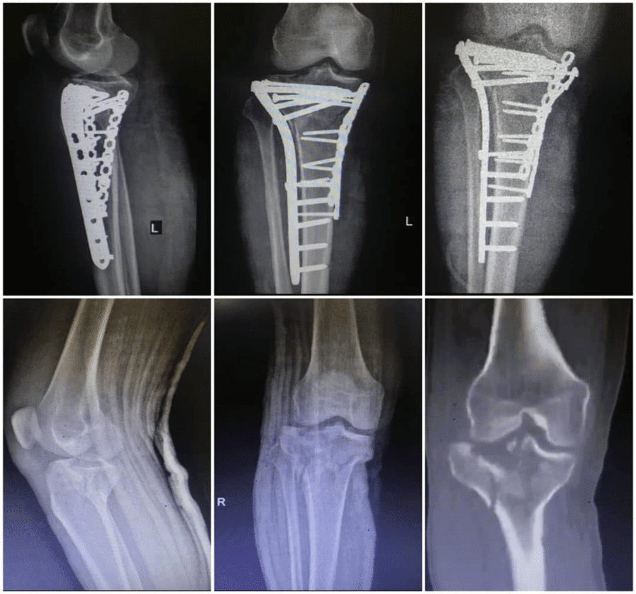 Outcome between Early and Usual CPM Physiotherapy