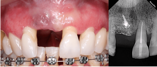 Clinical Management of Titanium Mesh Exposure Following Guided Bone ...