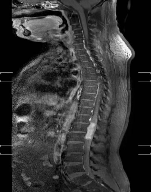 A Case Report of Conus Medullaris Tumor