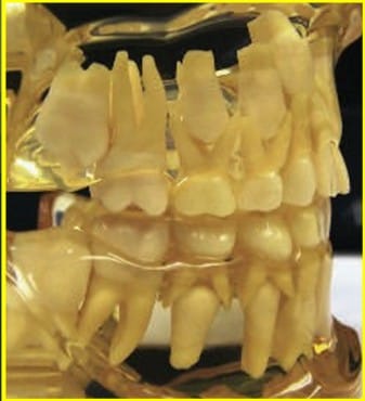 Endodontic Therapy for Primary and Young