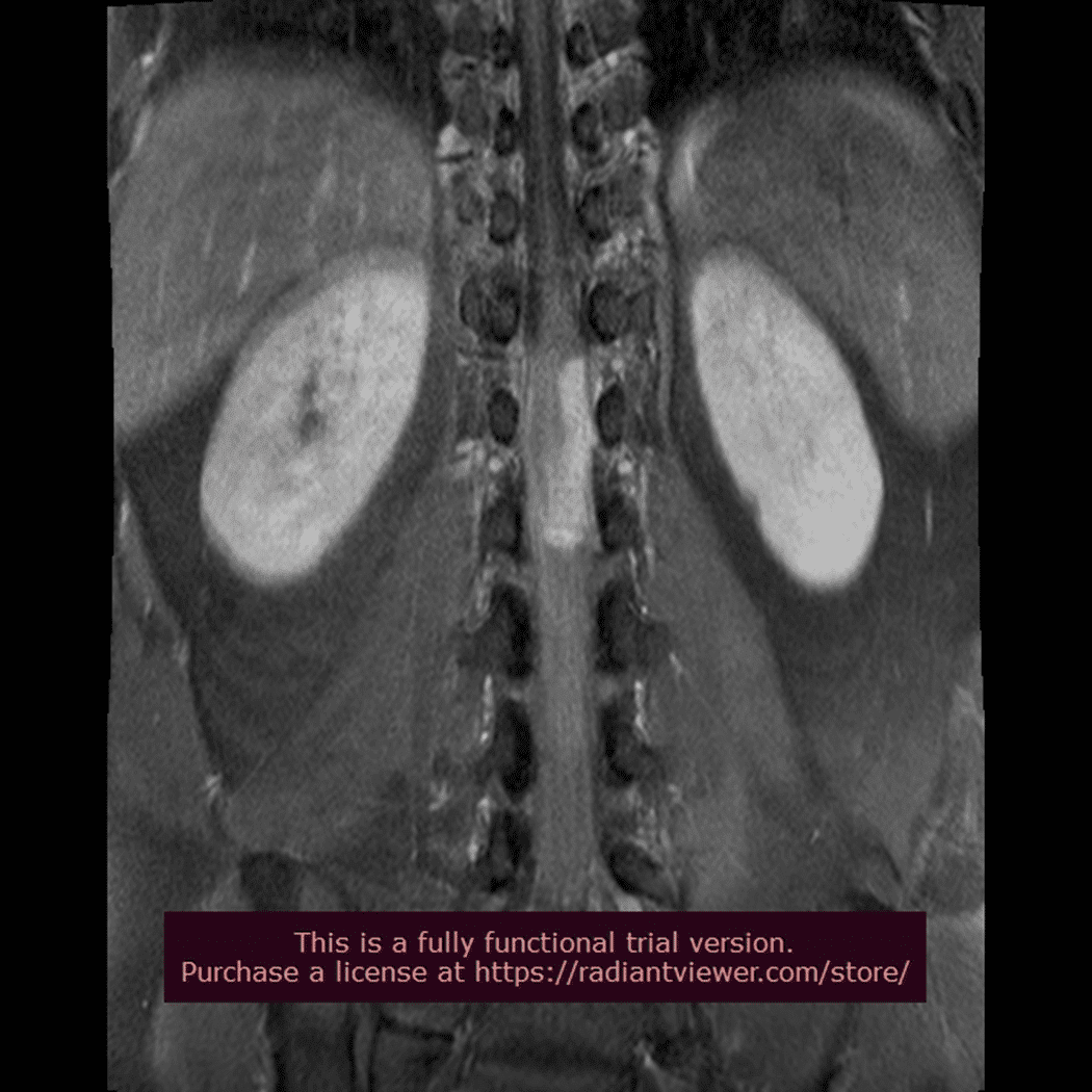 A Case Report of Conus Medullaris Tumor