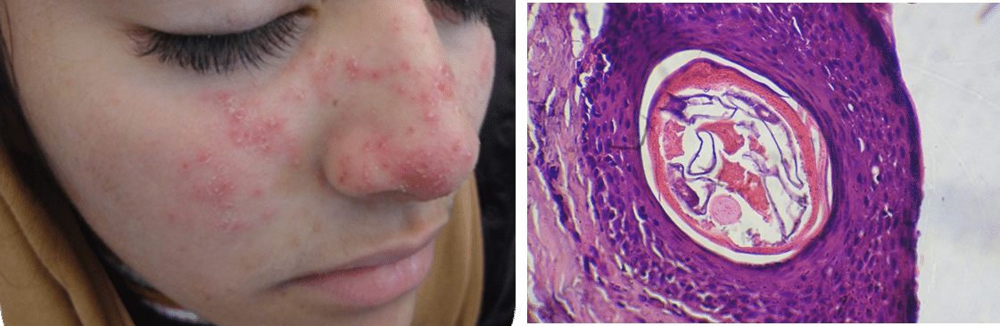 Clinicopathological Correlation in Dermatopathology