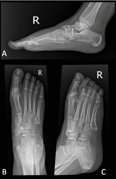 Treatment with Regenerative Distraction Arthroplasty