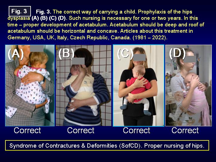 Syndrome of Contractures and Deformities (SofCD)